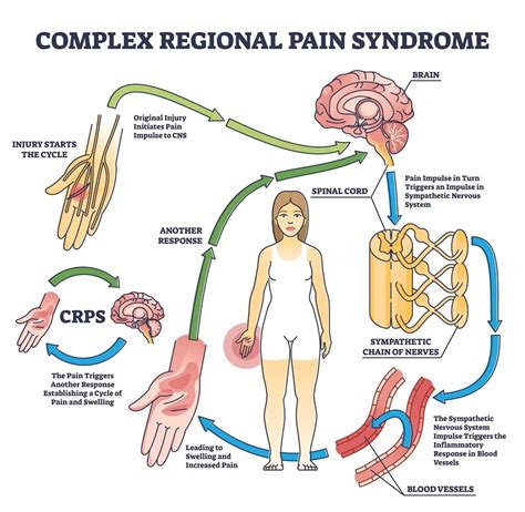 Complex Regional Pain Syndrome The Signs And Symptoms