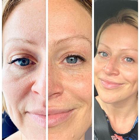 Heart Radio Presenter Emma Lenney Tries My Zone Face Lift Treatment