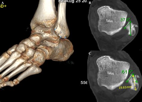 Postoperative 3d Ct Scan A A Anteror Fibular Tubercleaft B Bone