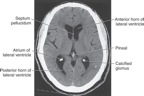 The Ventricles Choroid Plexus And Cerebrospinal Fluid Clinical Gate
