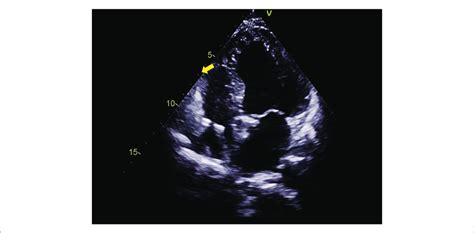Echocardiogram Showing Septal Electrode Tip Arrow Download