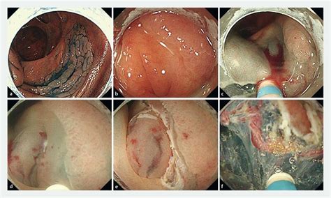 Case No 2 Resection Circumventing The Diverticulum Type 1 Flat Download Scientific