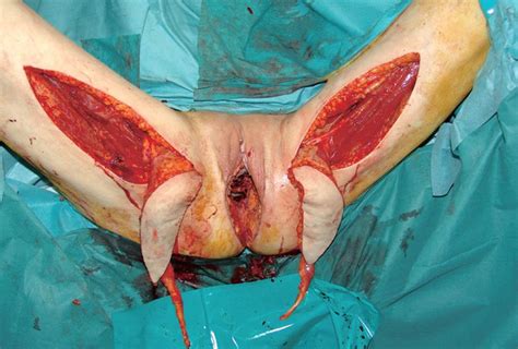 Surgical Treatment Of Locally Advanced Anal Cancer After Male To Female