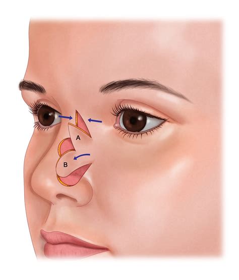 Best 10 Preparation And Recovery Of Mohs Surgery For Basal Cell Skin