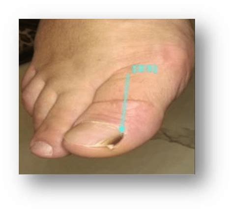 Clinical View Of Toe Hyperpigmentation Download Scientific Diagram