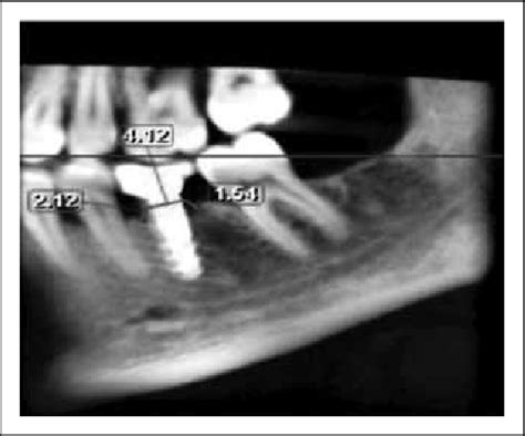 Postoperative Cbct Sections With Linear Bone Measurement At 6 Months Download Scientific