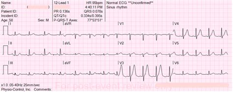 The Hyperacute T Wave