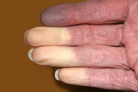 Raynauds Disease Au