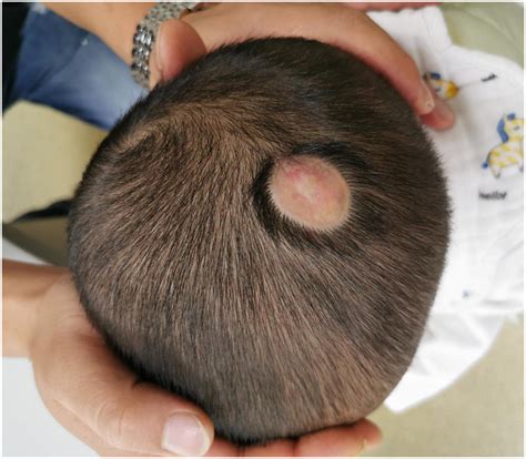Midline Cutaneous Anomalies Of The Craniospinal Axis Journal Of The