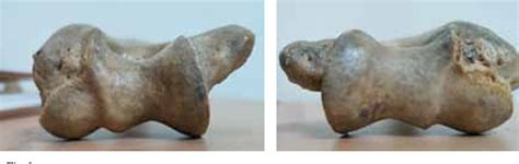 Figure 1 From Sex Determination From Lower End Of Humerus Using