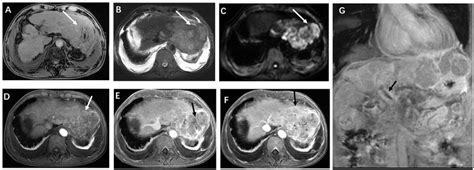 A Axial T1 Weighted Magnetic Resonance Imaging Mri And B Axial