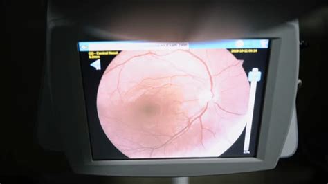 Optic Nerve Damage Stock Footage Royalty Free Video Clips Storyblocks