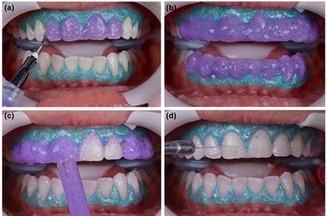 Bleaching Focus Dentistry