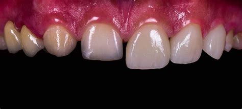 Veneers Procedure Lane Ends Dental Practice