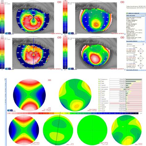 Preoperative Corneal Topography Sirius Tomographer Cso Italy And