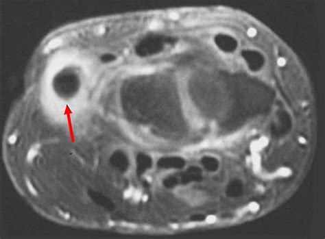 Tendinite Do Extensor Ulnar Do Carpo Instituto Salute