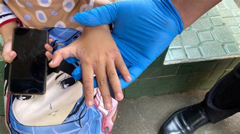 Foto Penyakit Kulit Scabies Bisa Menular Penyebabnya Menyeramkan