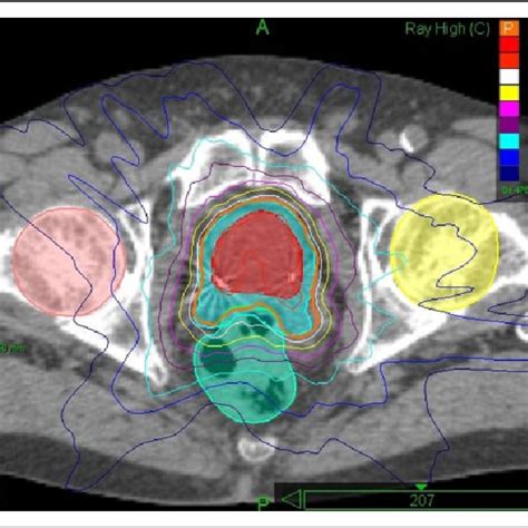 Advantages And Disadvantages Of Stereotactic Body Radiotherapy