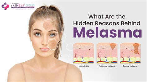 What Are The Hidden Reasons Behind Melasma