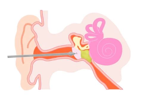 Best Myringotomy Doctor In Mumbai Ent Specialist In Mumbai