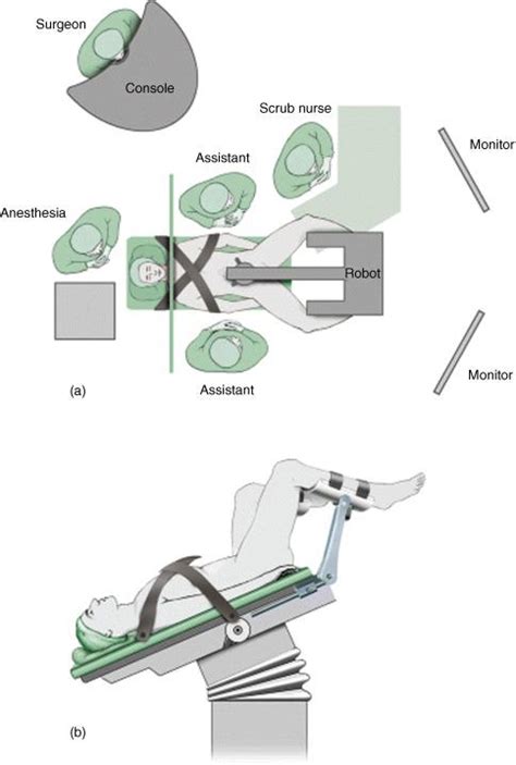 The Technique Of Robotic Nerve Sparing Prostatectomy Clinical Tree