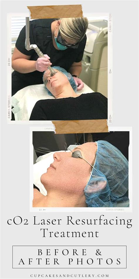Co2 Laser Skin Resurfacing Treatment And Recovery Before And After