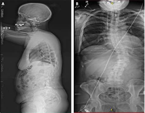 Coronal Deformity Clinical Tree