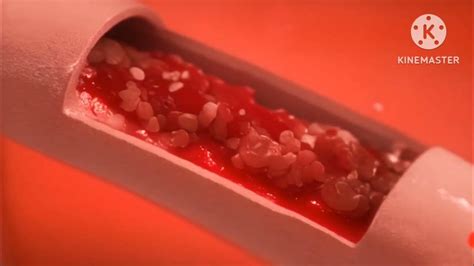 Alteraciones Cuantitativas De Los Leucocitos Leucopenia