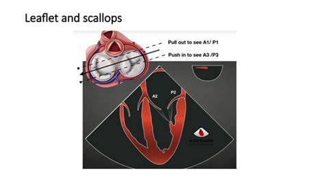 Evaluation Of Mitral Valve Tee Approach Pptx