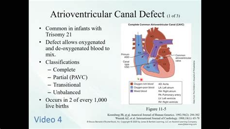 4 Atrioventricular Canal Defect
