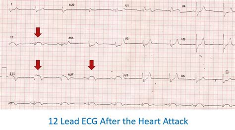 Heart Attack Ecg