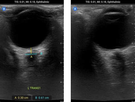 Optic Nerve Sheath Diameter