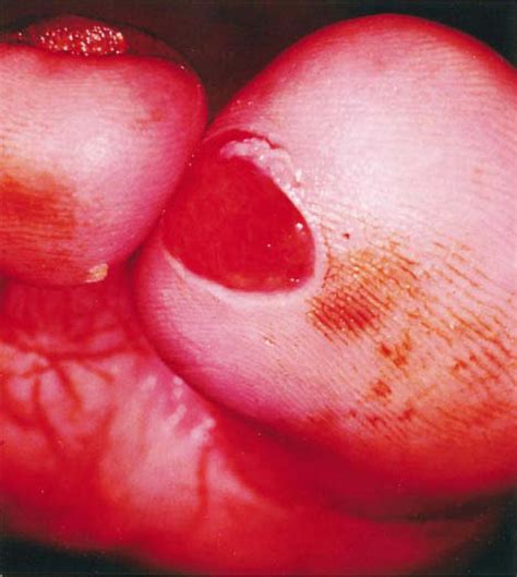 Piranha Attacks On Humans In Southeast Brazil Epidemiology Natural
