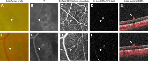 Practical Utility Of Widefield Oct Angiography To Detect Retinal