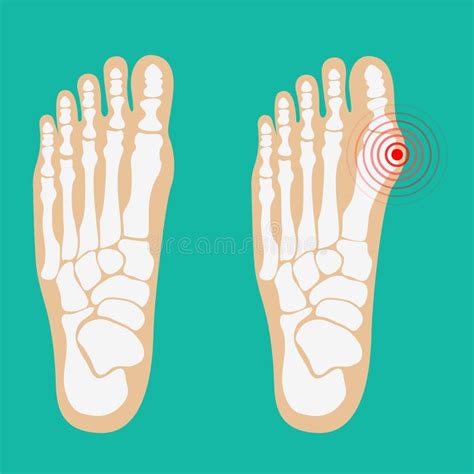 Valgus Deformity Of The Big Toe Foot Health Care Stock Vector