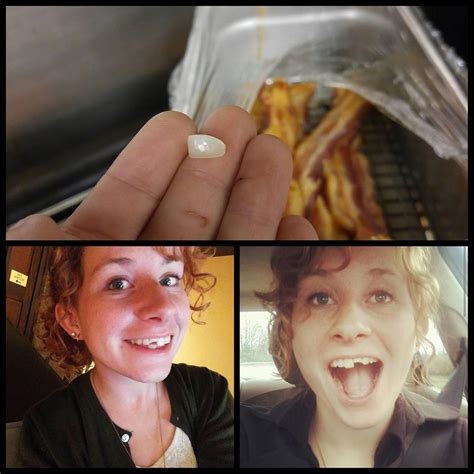 Today I Celebrate The 2 Year Anniversary Of Breaking Off My Front Tooth By Breaking Off The