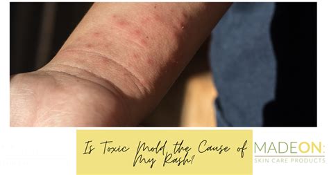 Symptoms Of Toxic Mold Exposure Madeon Skin Care