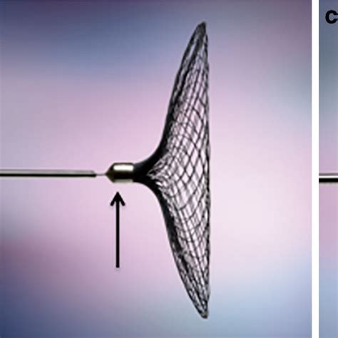 The Contour Device Is Designed To Sit At The Neck Of An Aneurysm And