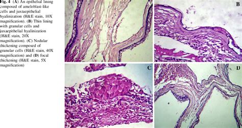 A An Epithelial Lining Composed Of Ameloblast Like Cells And