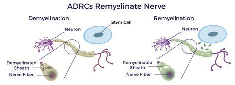 Ambrose Cell Therapy For Neuropathy And Peripheral Nerve Pain