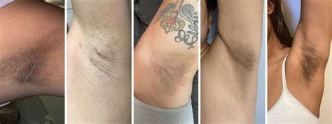 Acanthosis Nigricans Before And After