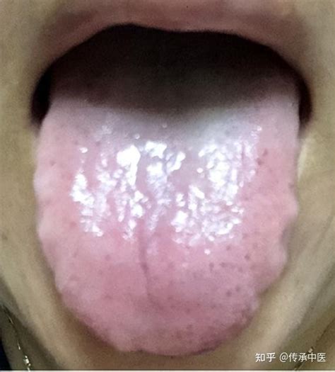 脾虚的尽头是 肿瘤”?脾虚的6个发展阶段,症状舌象及调理办法 知乎 脾虚的尽头是 肿瘤”?脾虚的6个发展阶段,症状舌象及调理办法 知乎