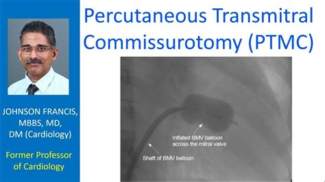 Percutaneous Transmitral Commissurotomy Ptmc Youtube