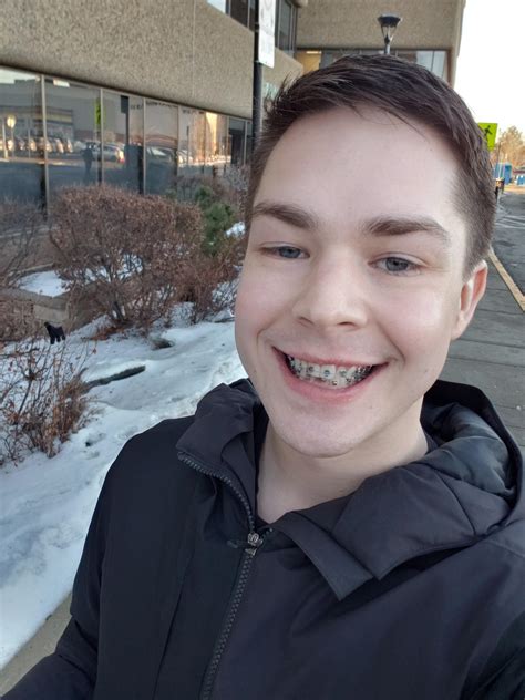 Anyone Using The Brius Lingual Braces R Braces