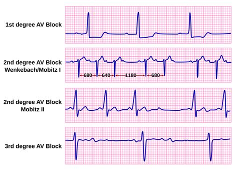 Difference Between First Degree Heart Block And Second Degree Heart