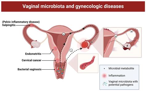 Vaginal Inflammation