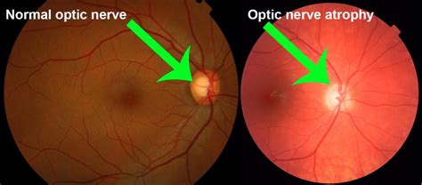 Optic Nerve