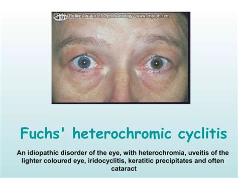 Ophthalmology Eponyms Ppt Eye And Vision Conditions Diseases