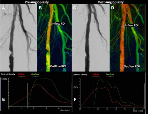 Example Of 2d Perfusion Angiography Pre And Post Balloon Angioplasty