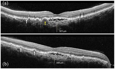 Subretinal Fluid In Eye